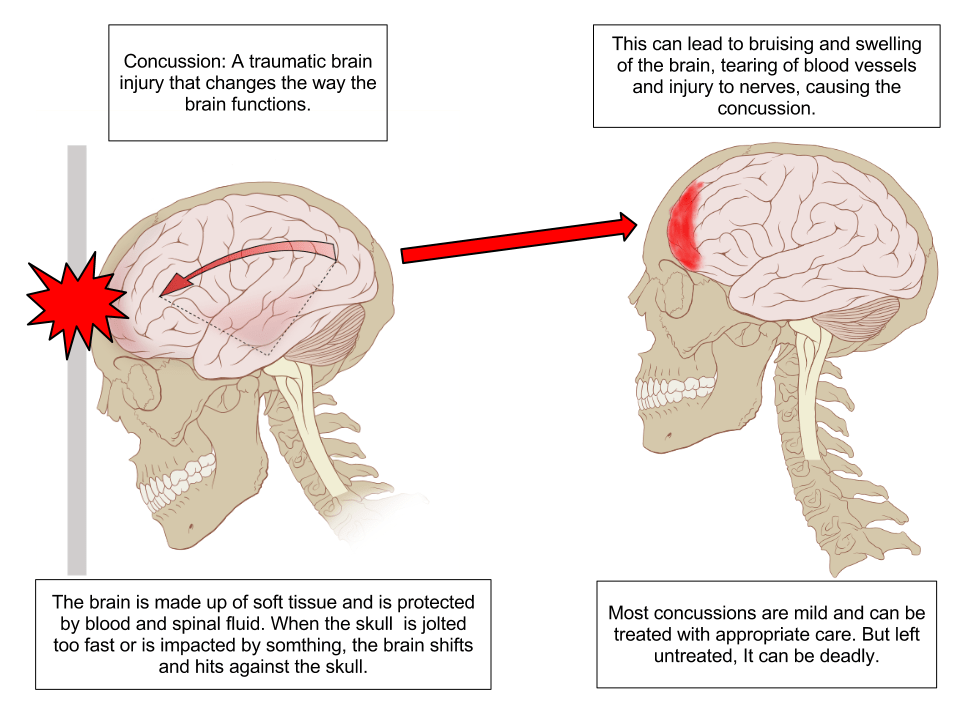 Concussions & Traumatic Brain Injury - MyBrainDR