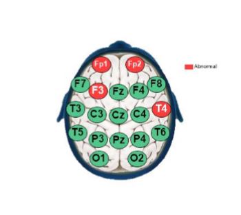 Concussions & Traumatic Brain Injury - MyBrainDR